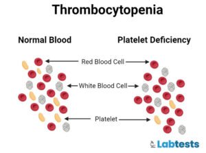 Mean platelet volume (MPV) blood test- High and Low levels ...