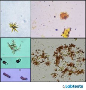 Urinary Crystals: Types, Causes, and Clinical Significance