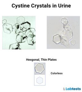 Urinary Crystals: Types, Causes, and Clinical Significance