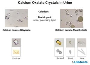 Urinary Crystals: Types, Causes, and Clinical Significance