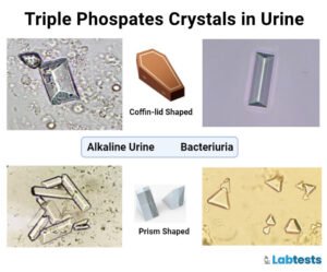 Urinary Crystals: Types, Causes, and Clinical Significance