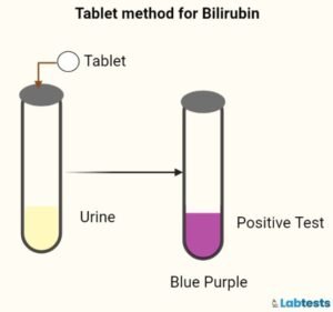 Blood (Serum) Bilirubin and Urine Bilirubin Tests : Normal range and ...