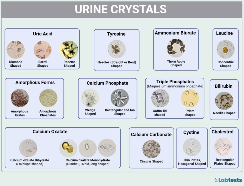 Urinary Crystals: Types, Causes, and Clinical Significance